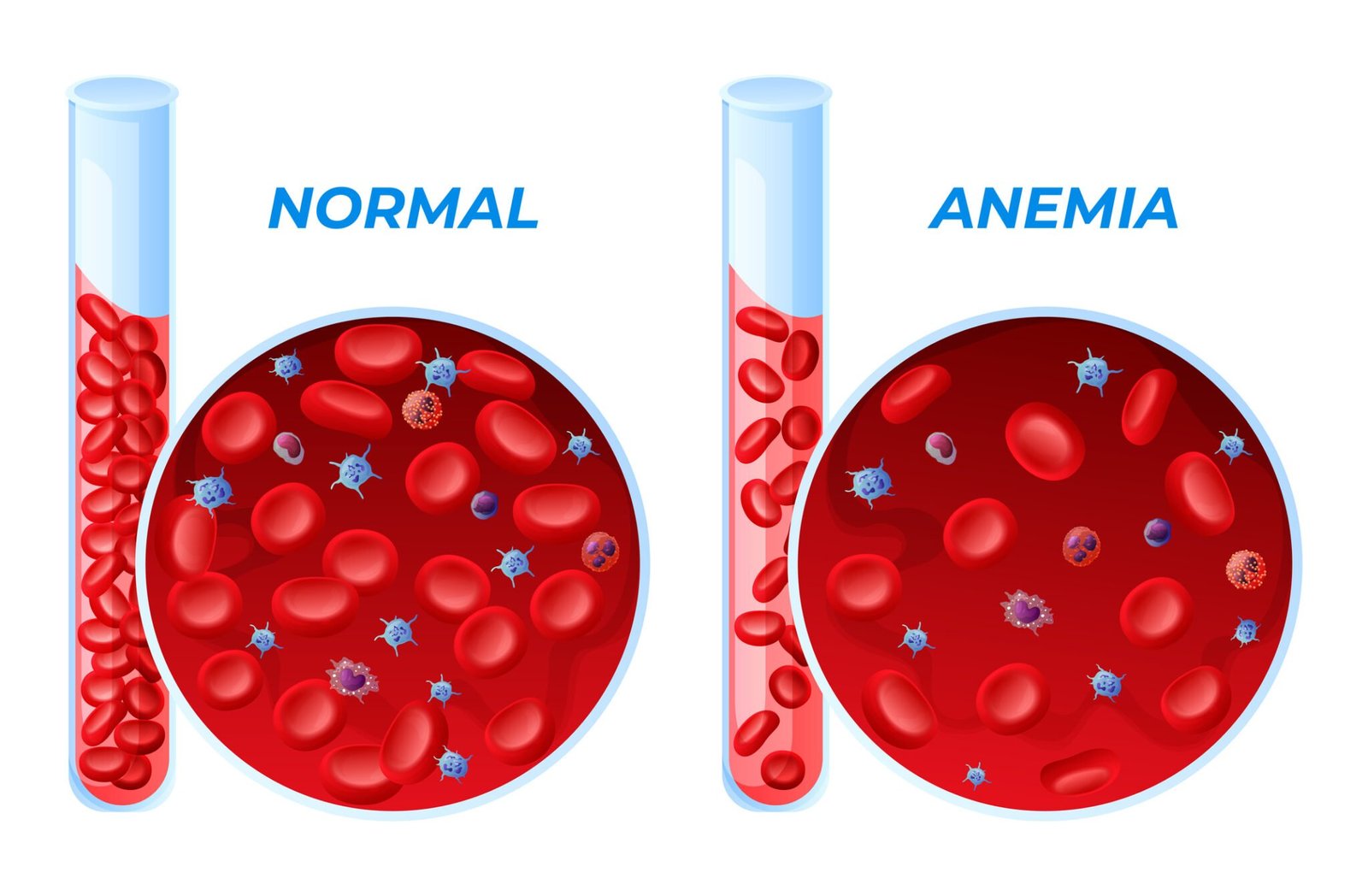 Anaemia- Causes, Diagnosis, Treatment and Prevention - Dr AvinashTank ...