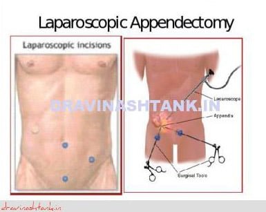 Laparoscopic Appendix Surgery Treatment & Benefits