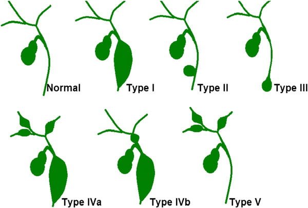 CHOLEDOCHAL CYST - Dr AvinashTank, is a super-specialist (MCh ...