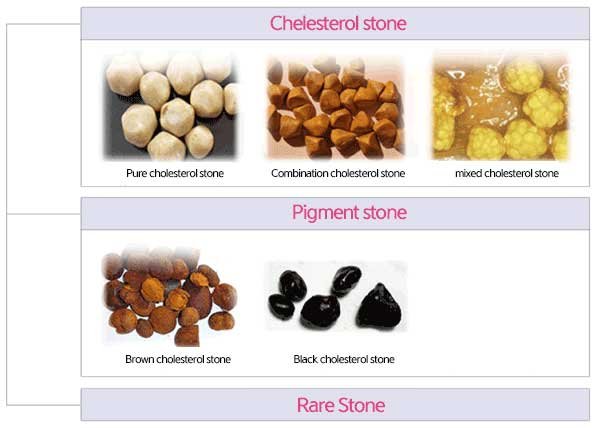 Gall Bladder Stone Surgery Specialist in Ahmedabad