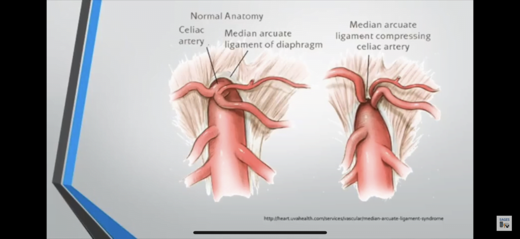 Arcuate Ligament