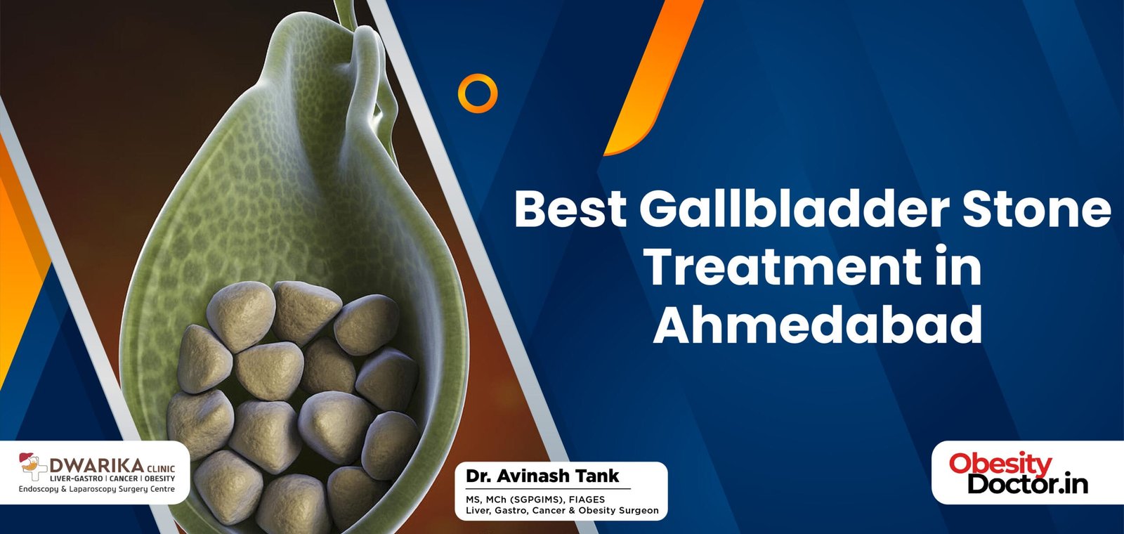 Best Gallbladder Stone Treatment in Ahmedabad - Dr AvinashTank, is a ...