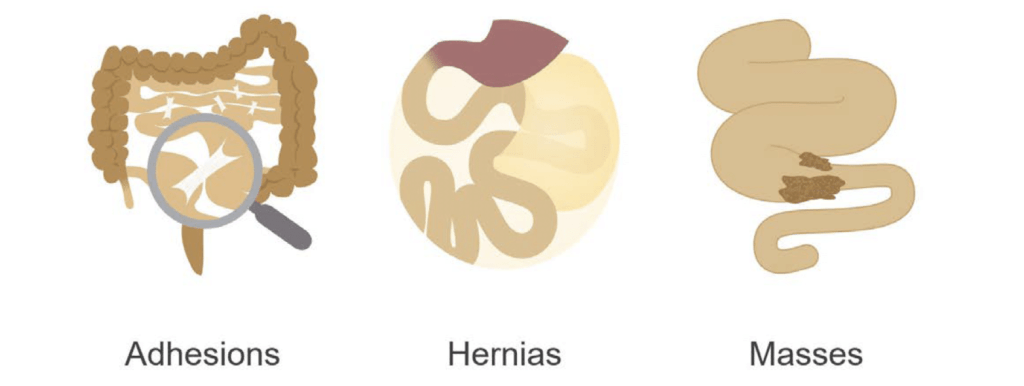 Bowel Obstruction and Constipation- Relation, Symptoms, Treatment ...