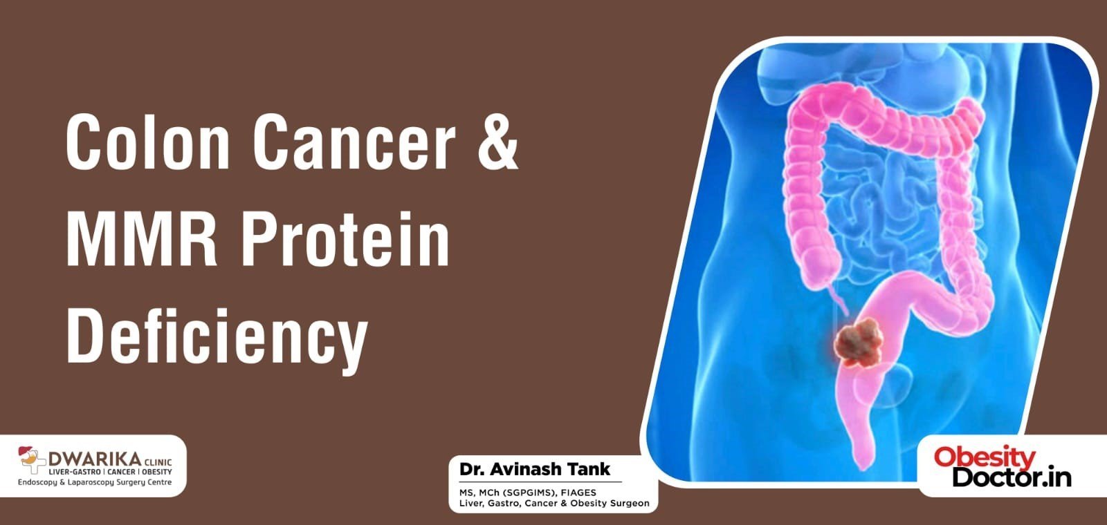 Colon Cancer & MMR Protein Deficiency - Dr AvinashTank, is a super ...