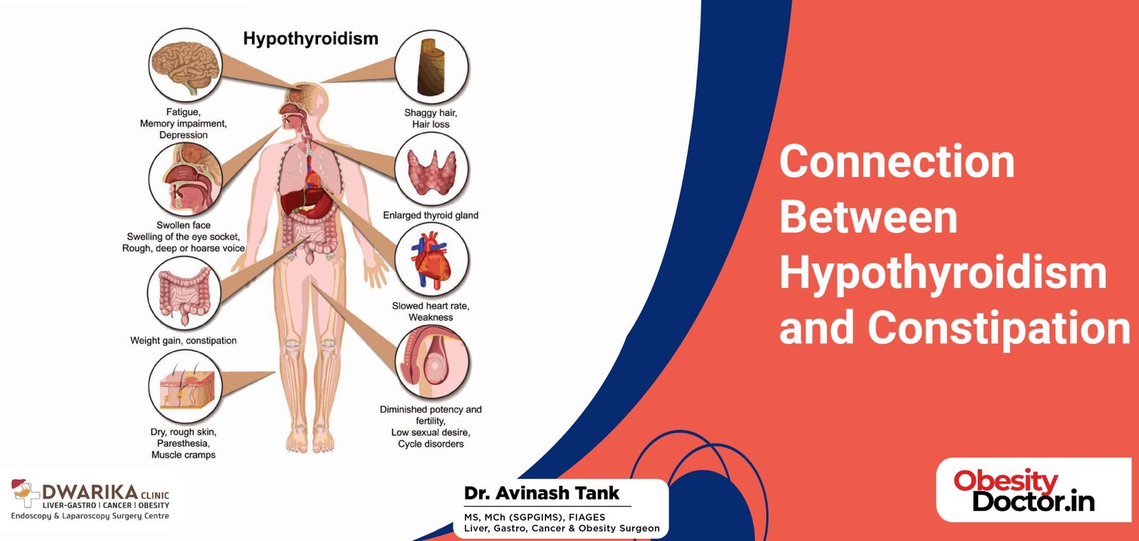 Connection Between Hypothyroidism and Constipation - Dr AvinashTank, is ...