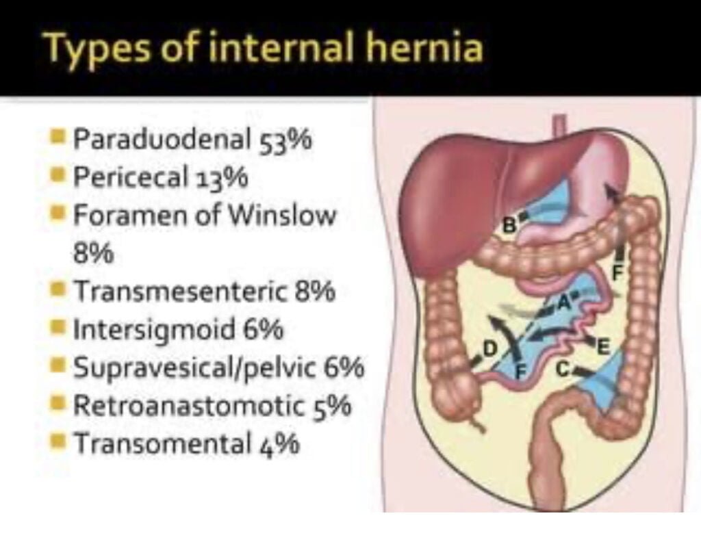 Internal Hernia: Types & Treatment. - Dr AvinashTank, is a super ...