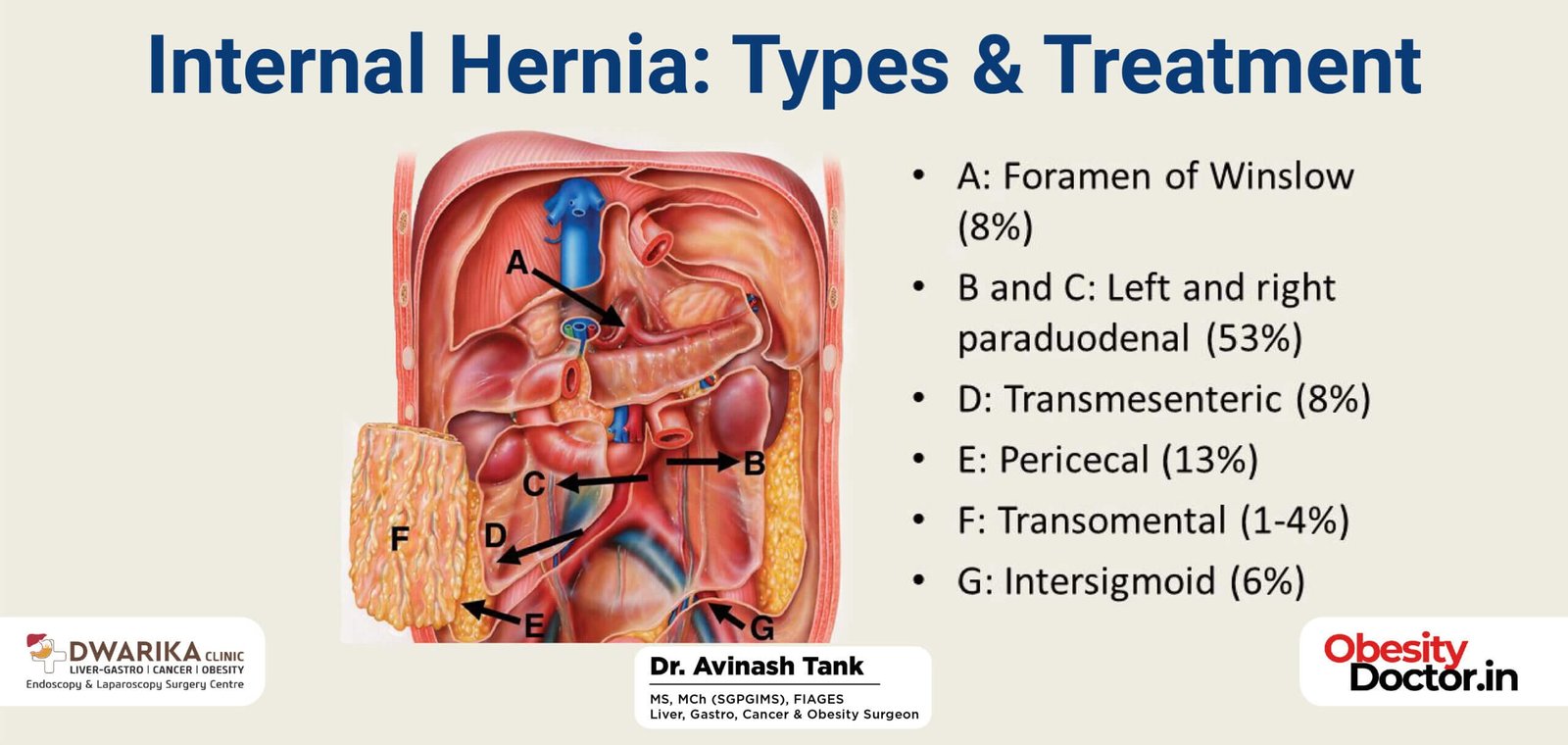 Internal Hernia: Types & Treatment. - Dr AvinashTank, is a super ...