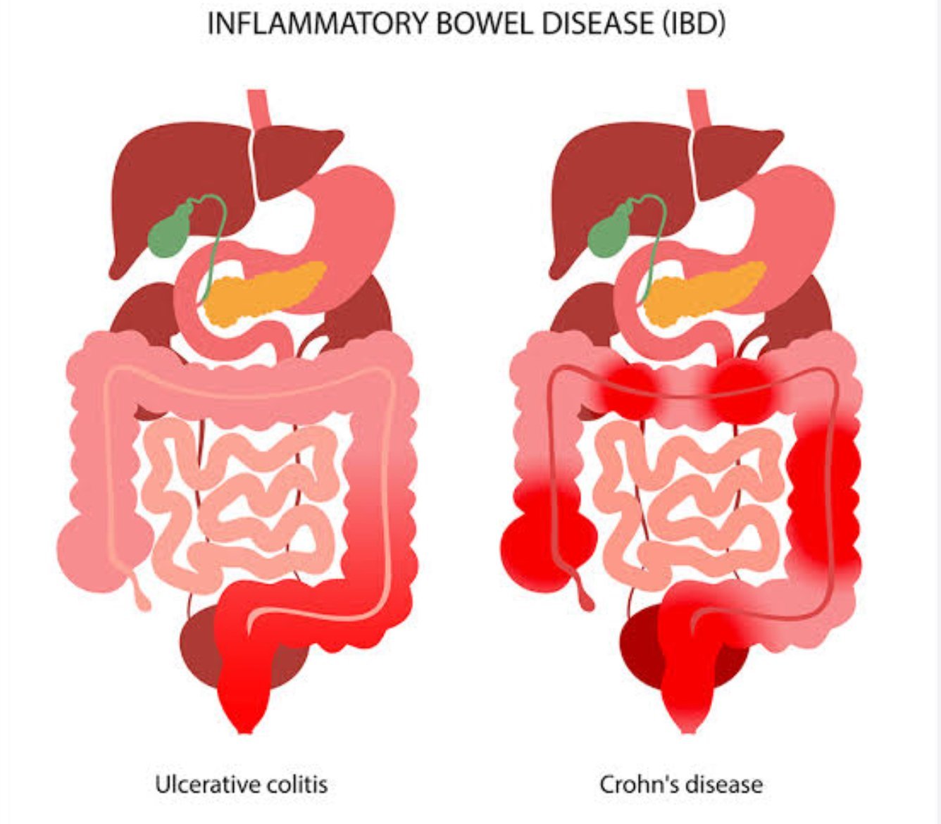 Malnutrition Risk in IBD Patients: Simple Screening Tool Offers Early ...