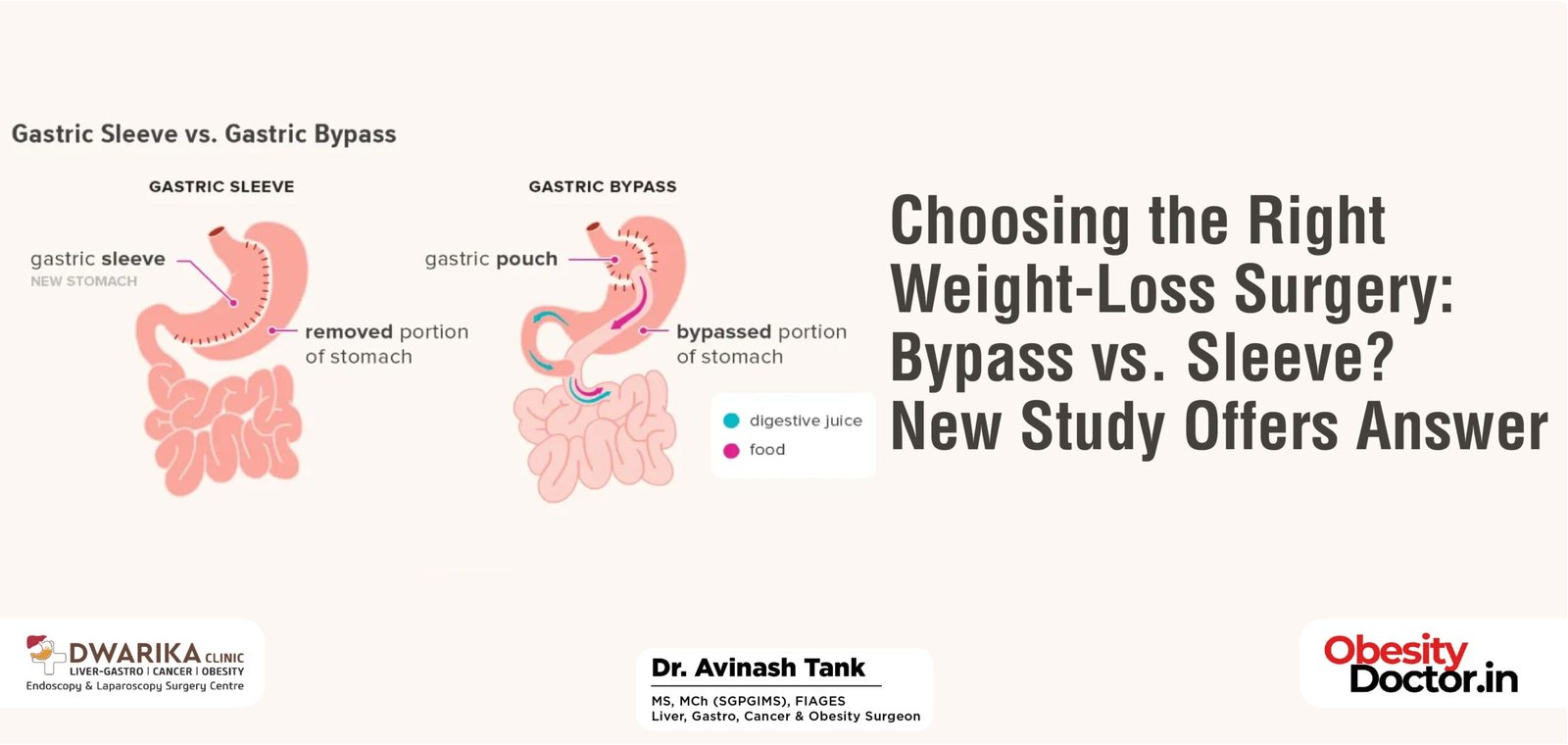 Choosing the Right Weight-Loss Surgery: Bypass vs. Sleeve? New Study ...