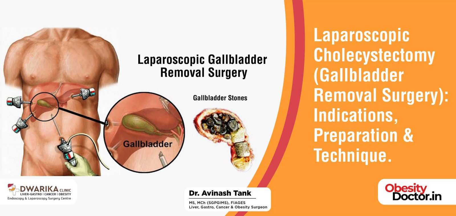 Laparoscopic Cholecystectomy ( Gallbladder Removal Surgery ...